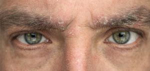 Got Eyebrow Dandruff? Here’s What Your Body’s Telling You